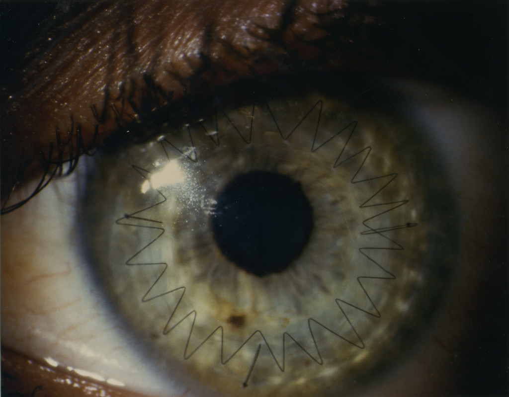 Lions Sight Program | Minnesota Lions Vision Foundation